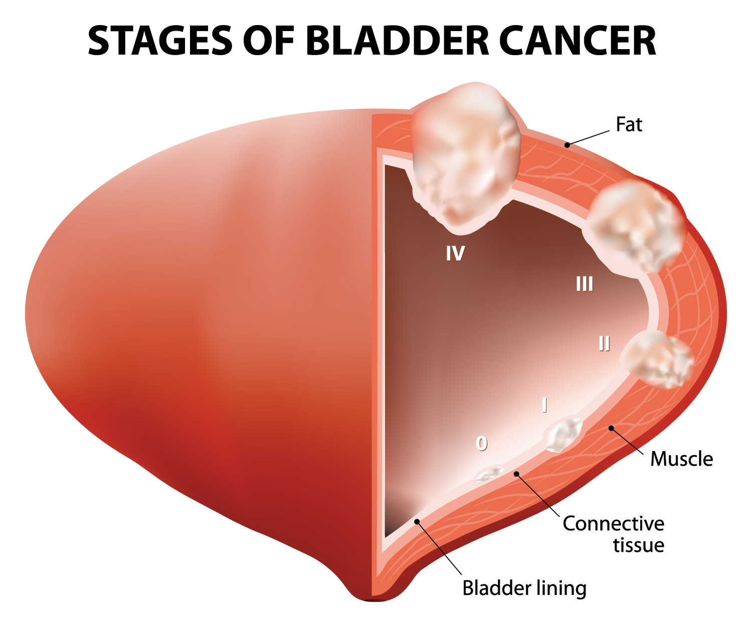 Bladder Cancer - DiseasesAndConditions.net