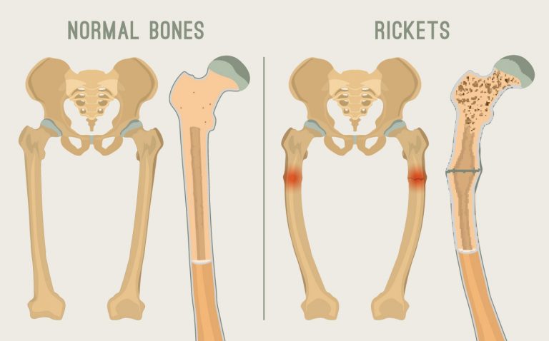 Rickets - DiseasesAndConditions.net