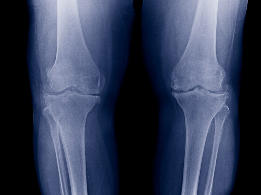 Hypophosphatemia - DiseasesAndConditions.net